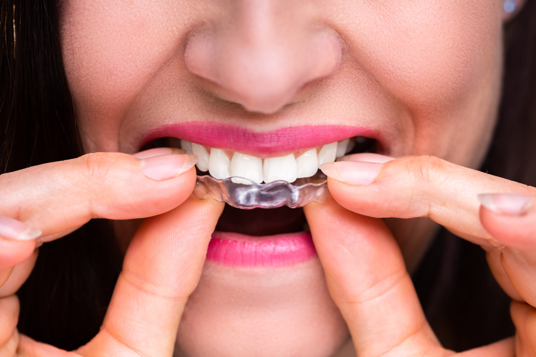 How Invisalign Improves Smiles - Riverside Dental Group
