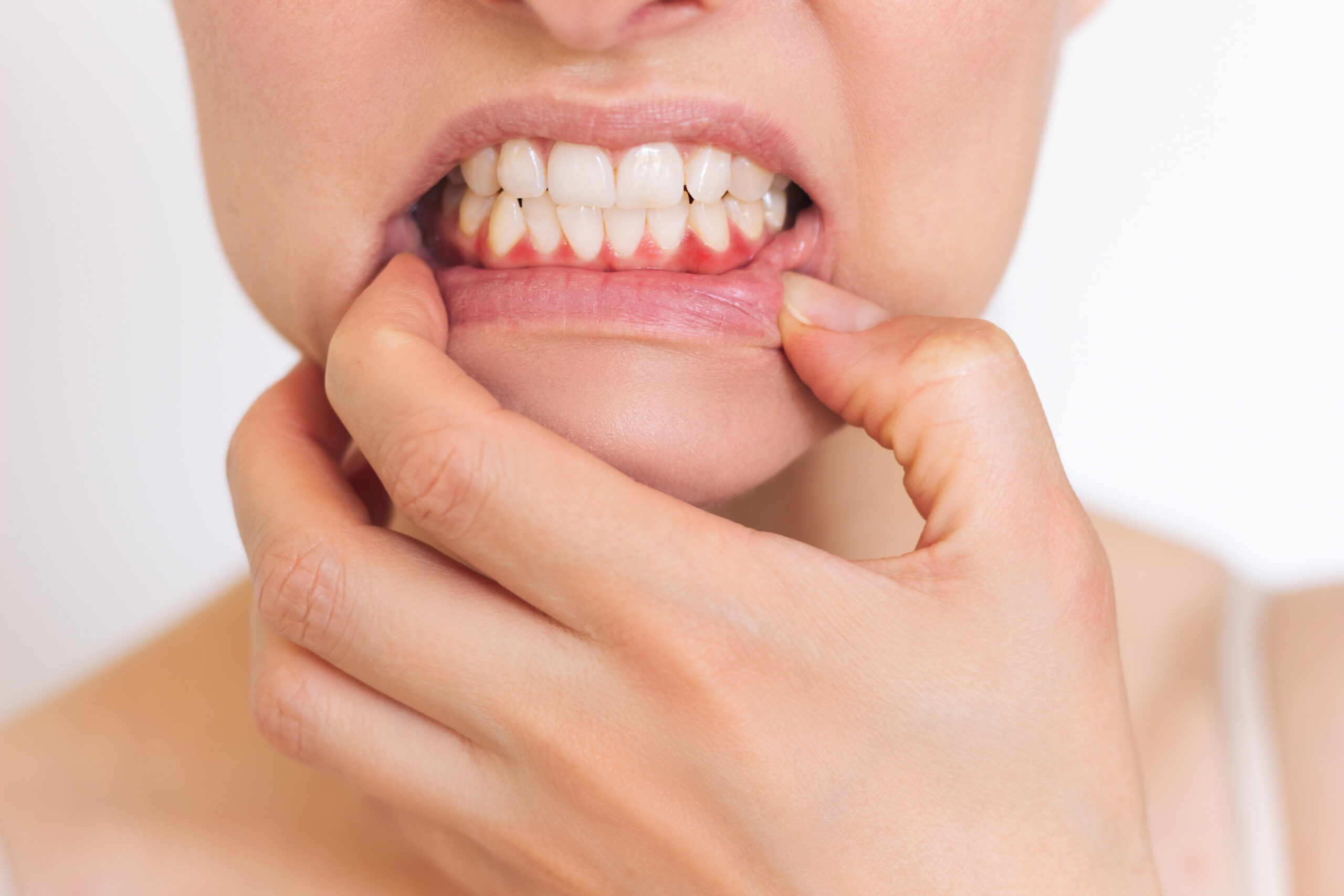What Is Periodontitis And How Can I Prevent It?