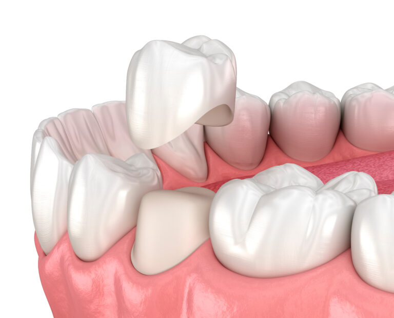 Repairing Smiles With Crowns - Riverside Dental Group