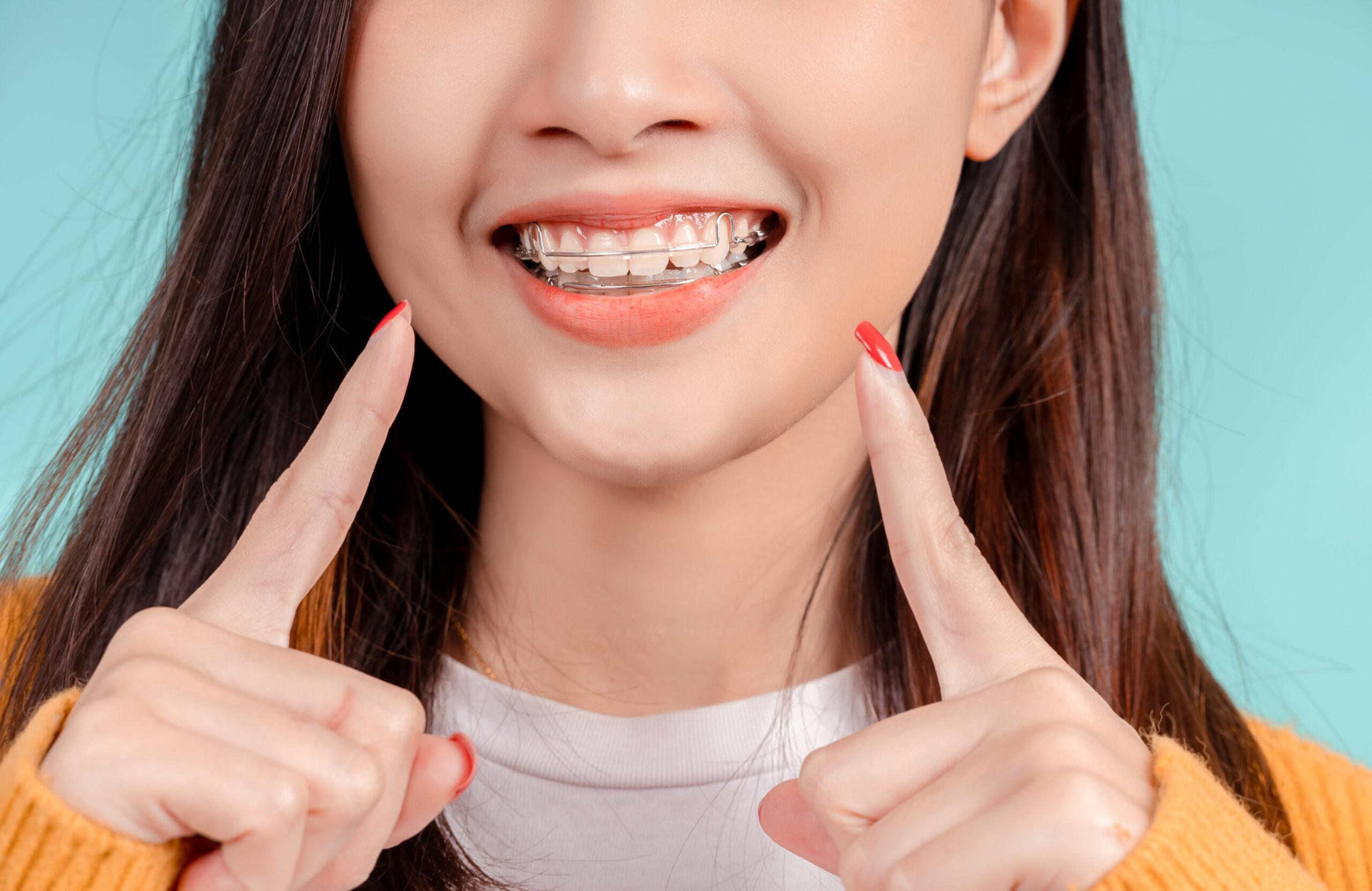 The Benefits Of Retainers - Riverside Dental Group