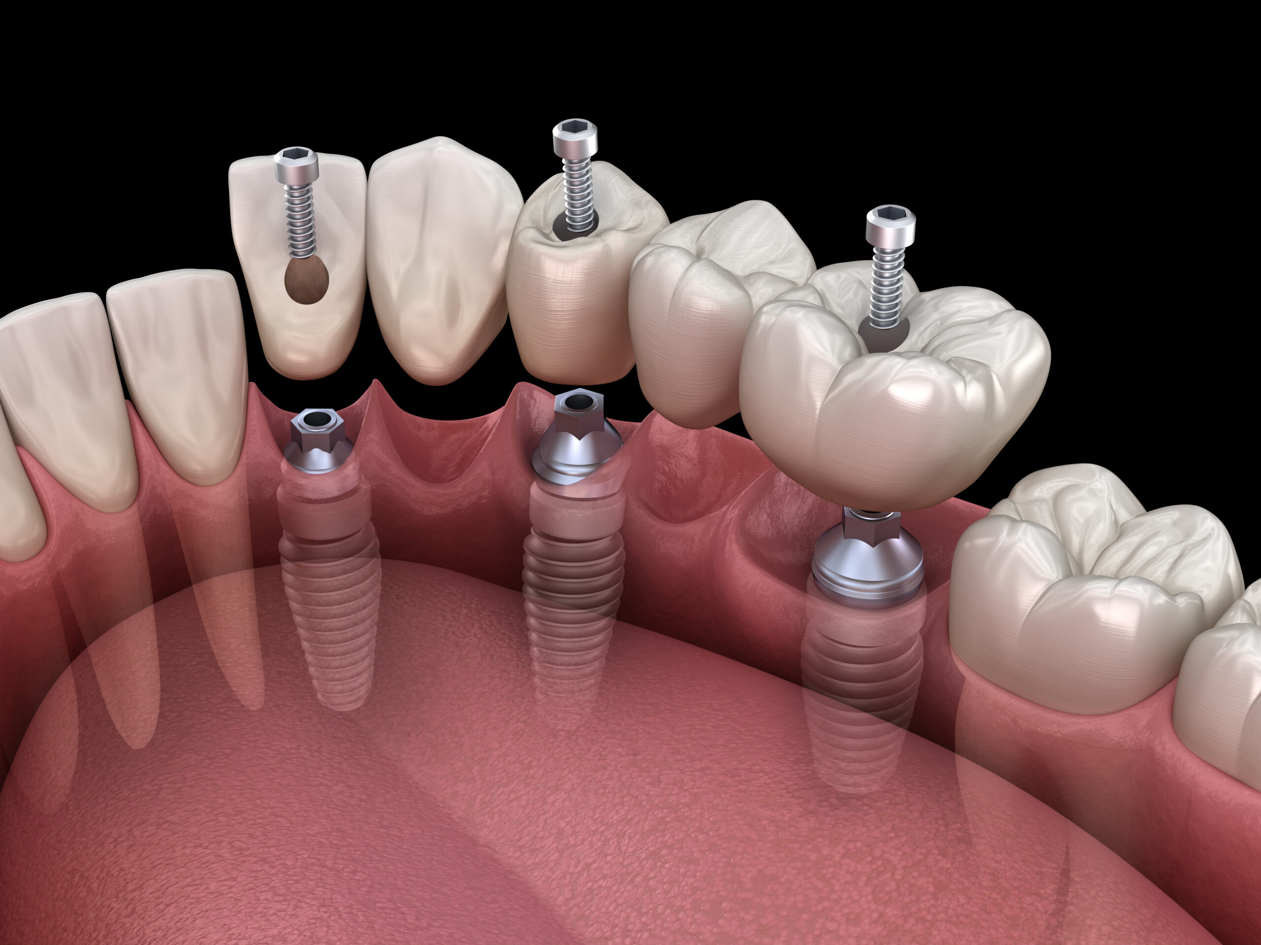 What Makes Dental Implants Stable? - Riverside Dental Group
