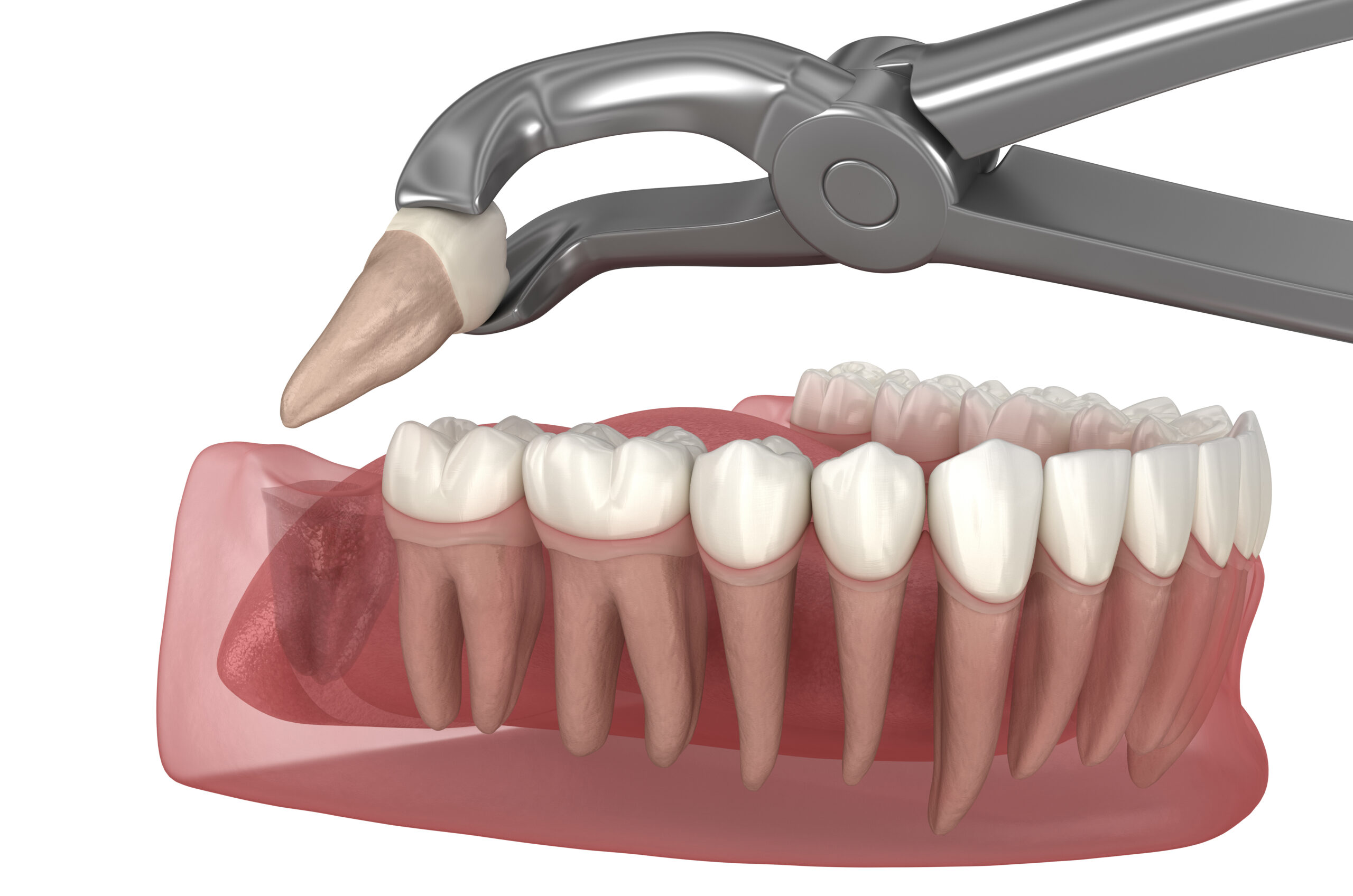 The Process Of Extracting A Tooth - Riverside Dental Group