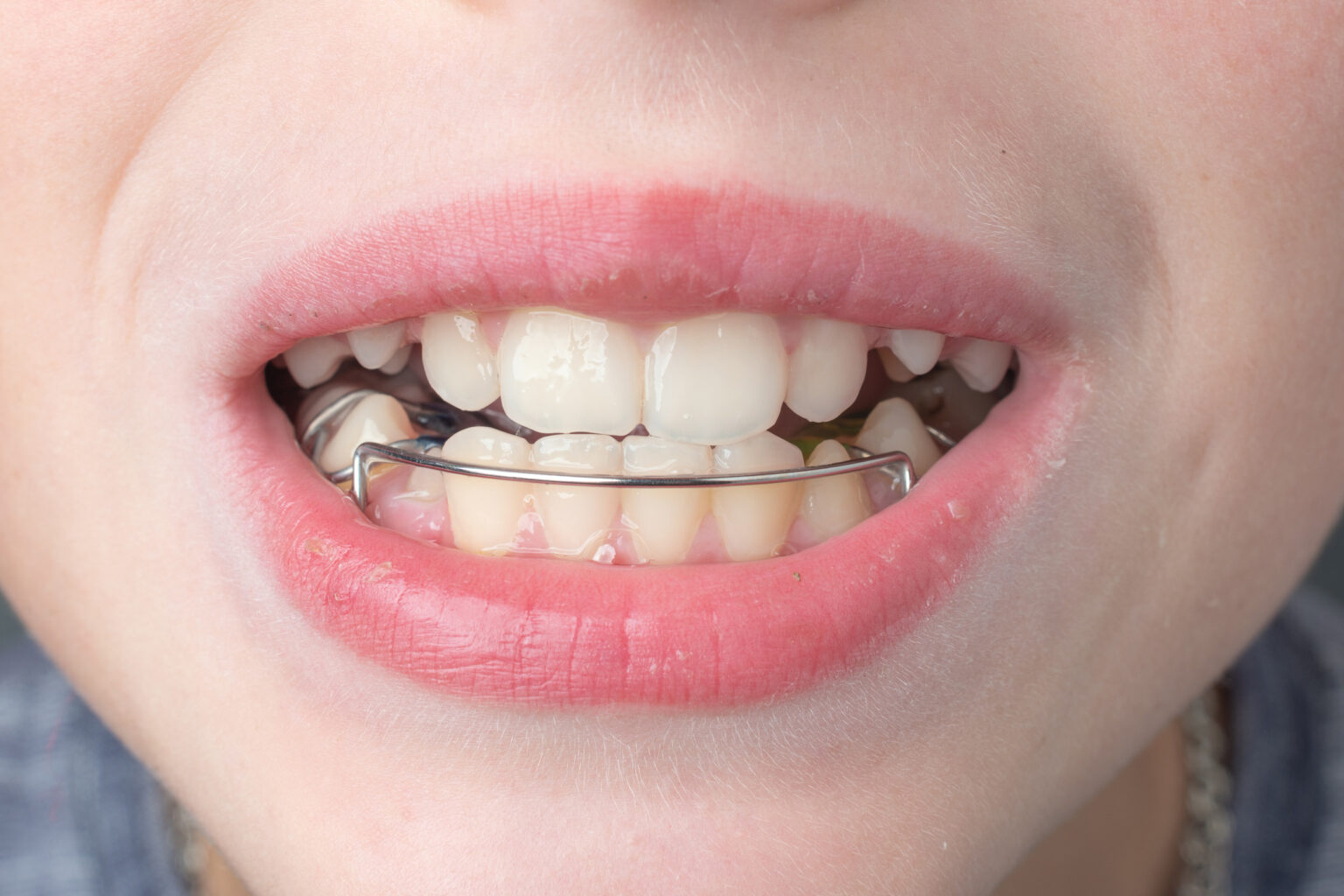 Treating Smiles With Phase One Orthodontics - Riverside Dental Group