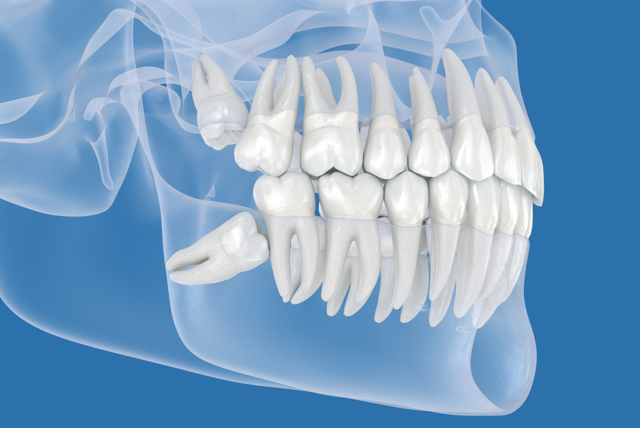Removing Your Wisdom Teeth - Riverside Dental Group