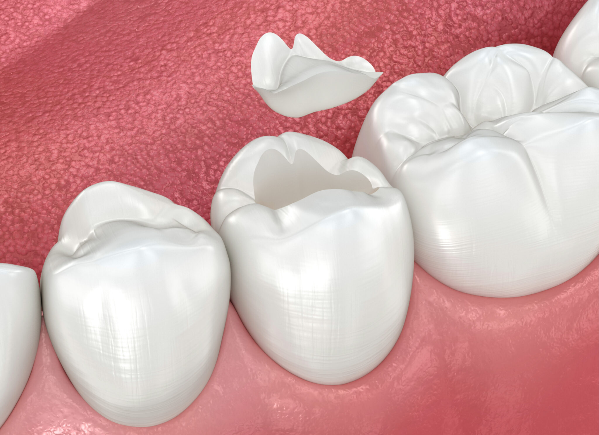 When A Tooth Needs An Inlay Or Onlay - Riverside Dental Group