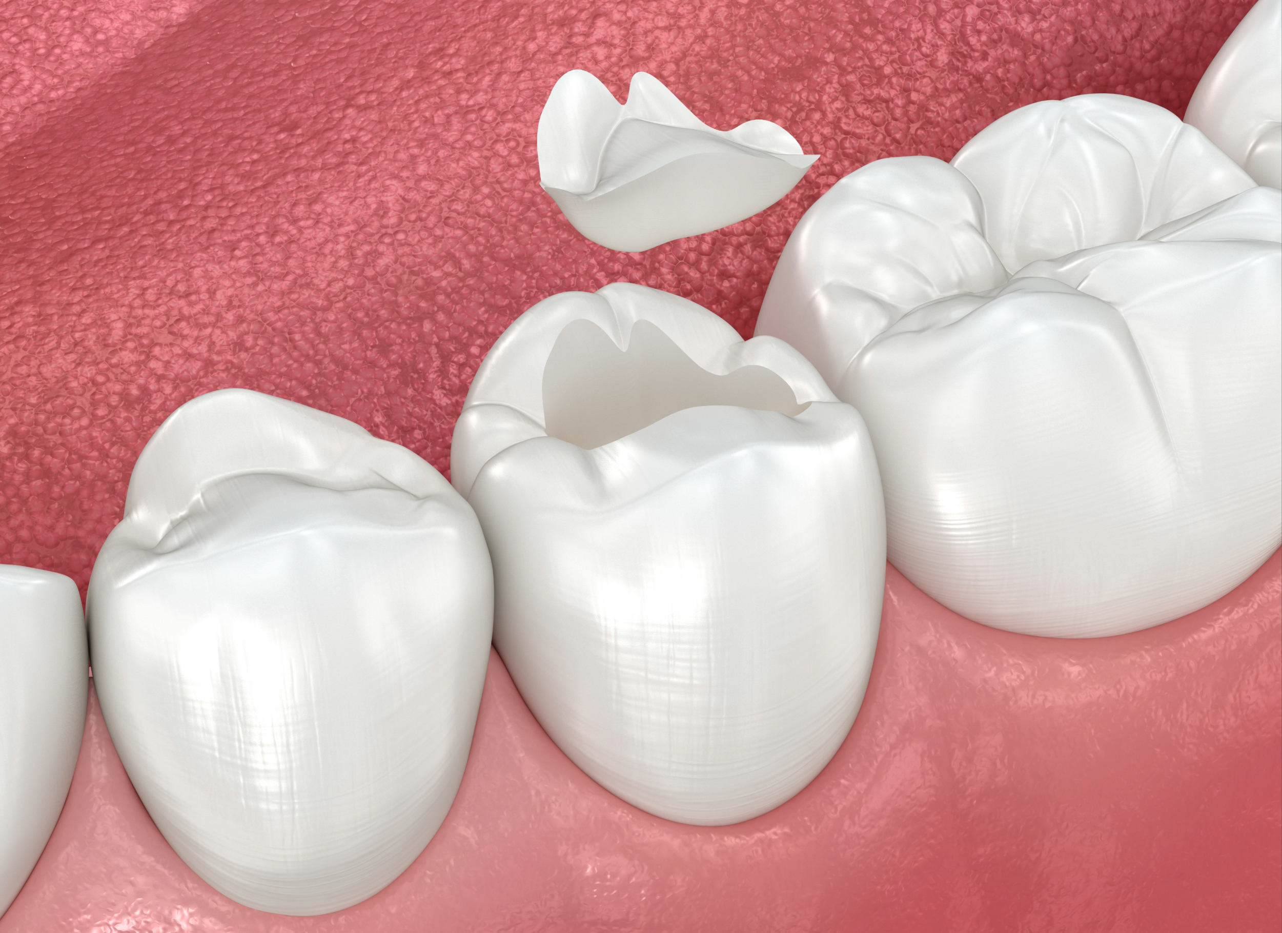 When A Tooth Needs An Inlay Or Onlay - Riverside Dental Group
