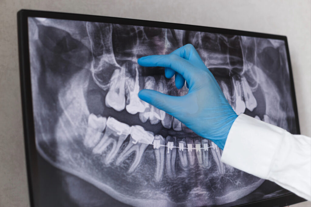 Replacing Teeth With Oral Surgery - Riverside Dental Group
