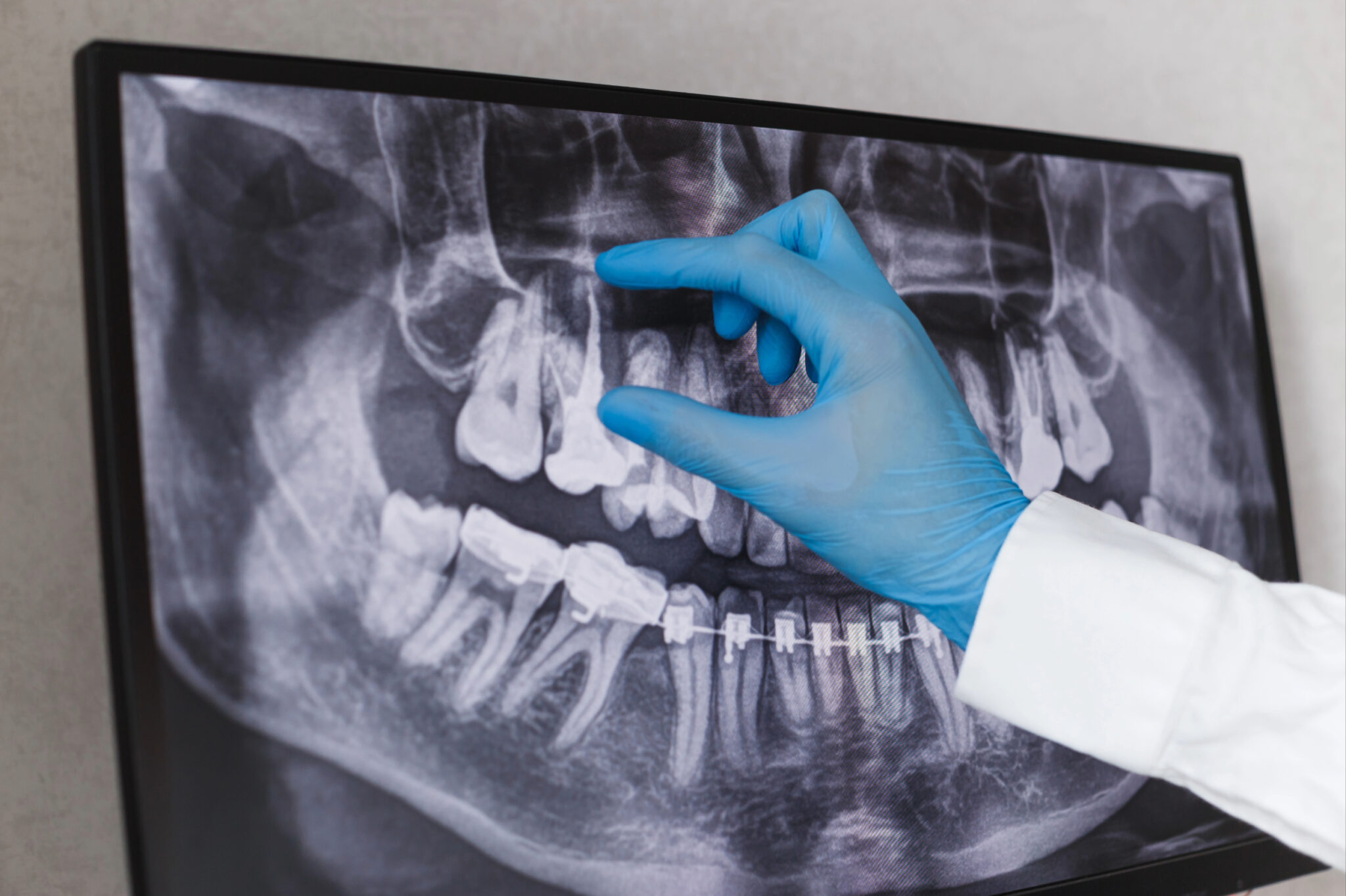 Replacing Teeth With Oral Surgery - Riverside Dental Group
