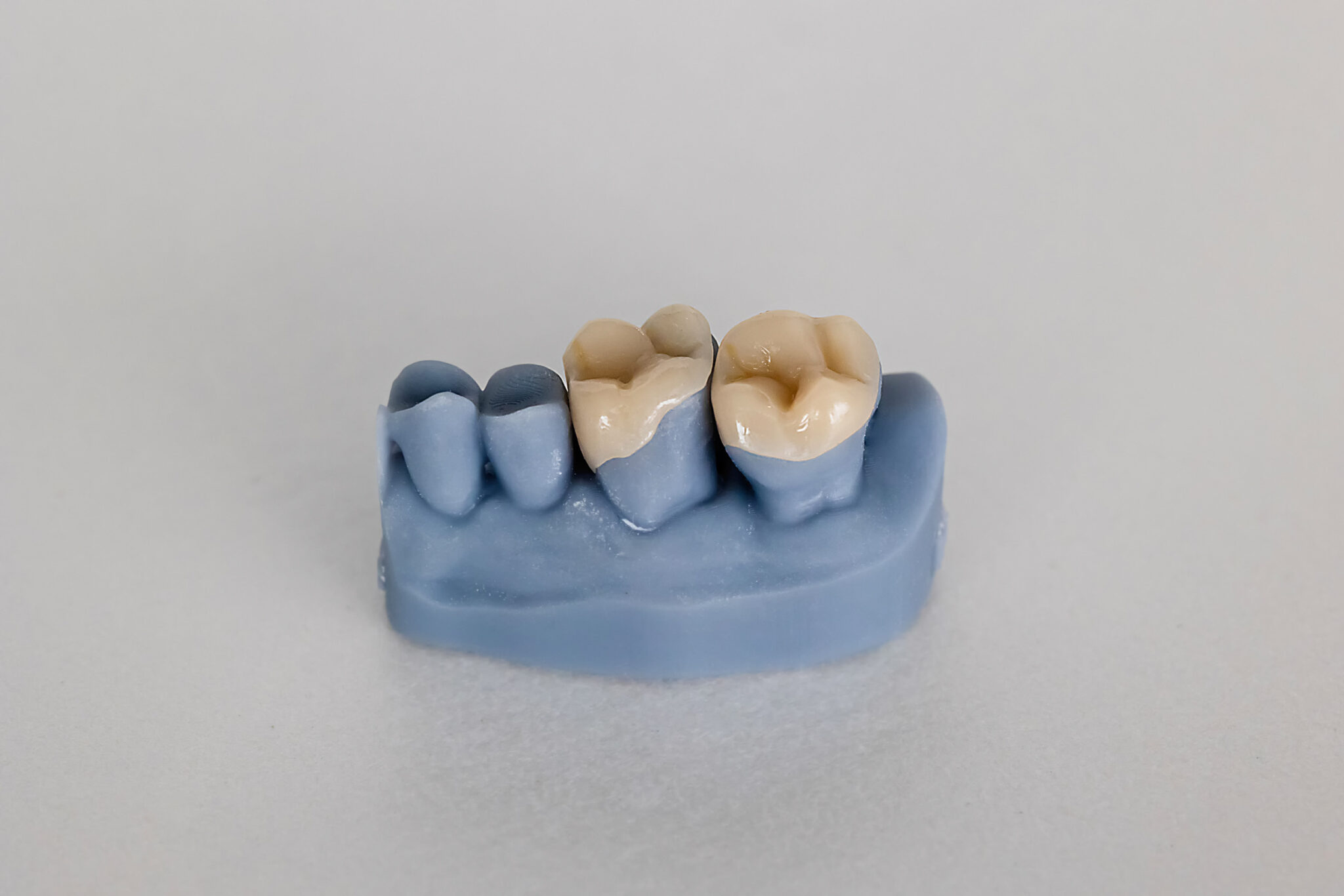 Custom Restorations Protect Smiles - Riverside Dental Group