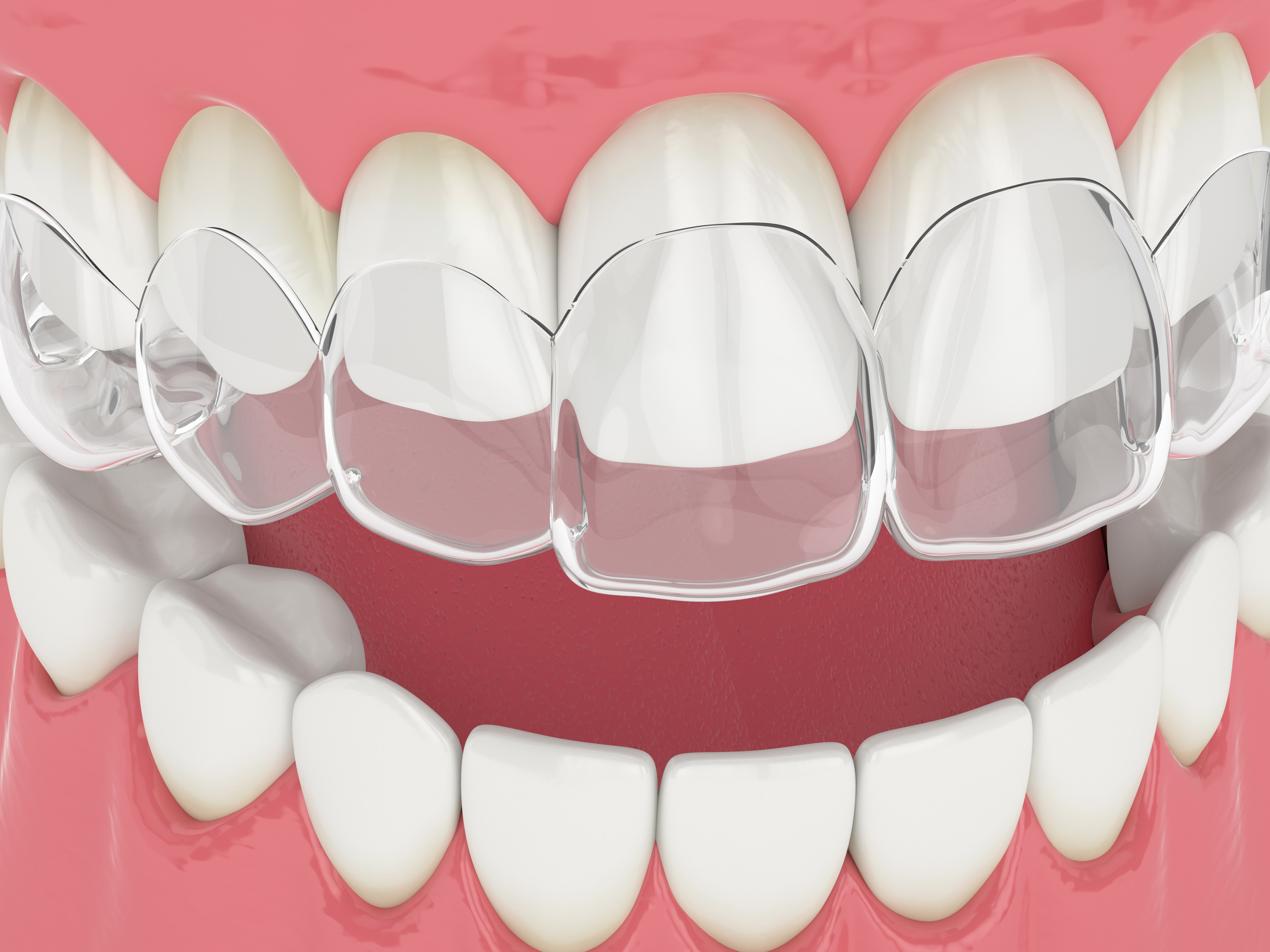 Invisalign Clear Smile Correction - Riverside Dental Group