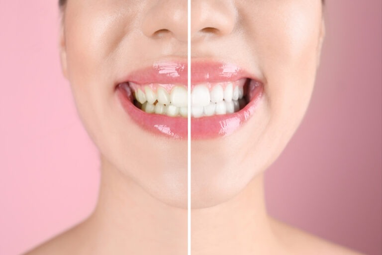 Brighten Smiles With Whitening - Riverside Dental Group